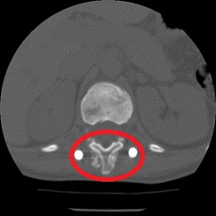 Traumatic L1 Vertebral Body Fracture