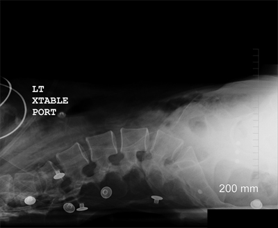 Traumatic L1 Vertebral Body Fracture