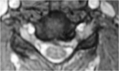 Cervical Radiculopathy: Classic Case?