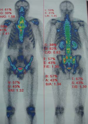 Low Back Pain with L1-L3 Degeneration and L1-L2 Instability