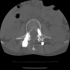 Traumatic L1 Vertebral Body Fracture