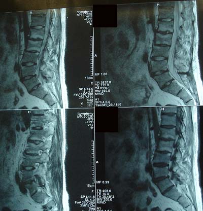 Low Back Pain with L1-L3 Degeneration and L1-L2 Instability