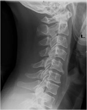 Cervical Degenerative Disc Disease in 34-Year-Old Male