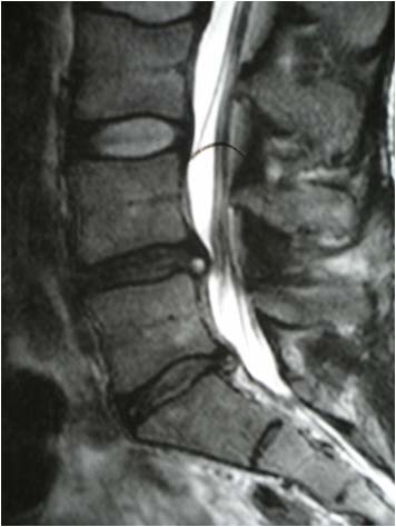 Degenerative Disc Disease at L4-L5 and L5-S1