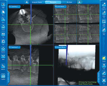 T12-L3 Fixation across L2: Burst Fracture