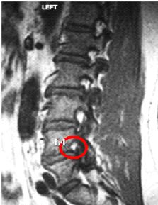 Construction Worker with Increasing Low Back Pain and Bilateral Leg Pain