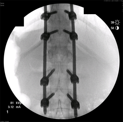 Traumatic L1 Vertebral Body Fracture