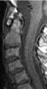 Lytic Lesion of the C2 Body