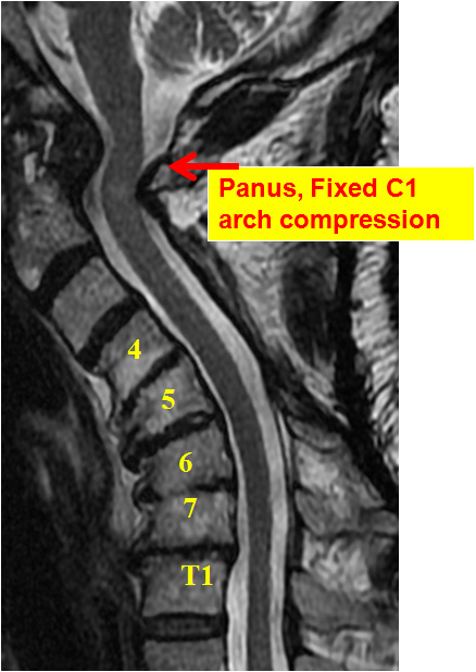 Cervical Kyphosis Mri