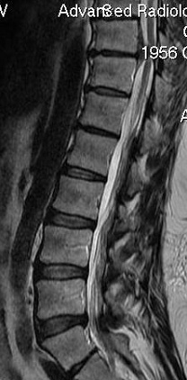central herniation spine
