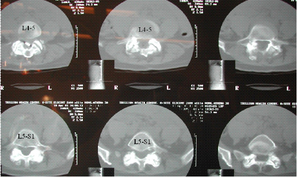 Spine Case | Previous Harrington Rod Causing Low Back Pain