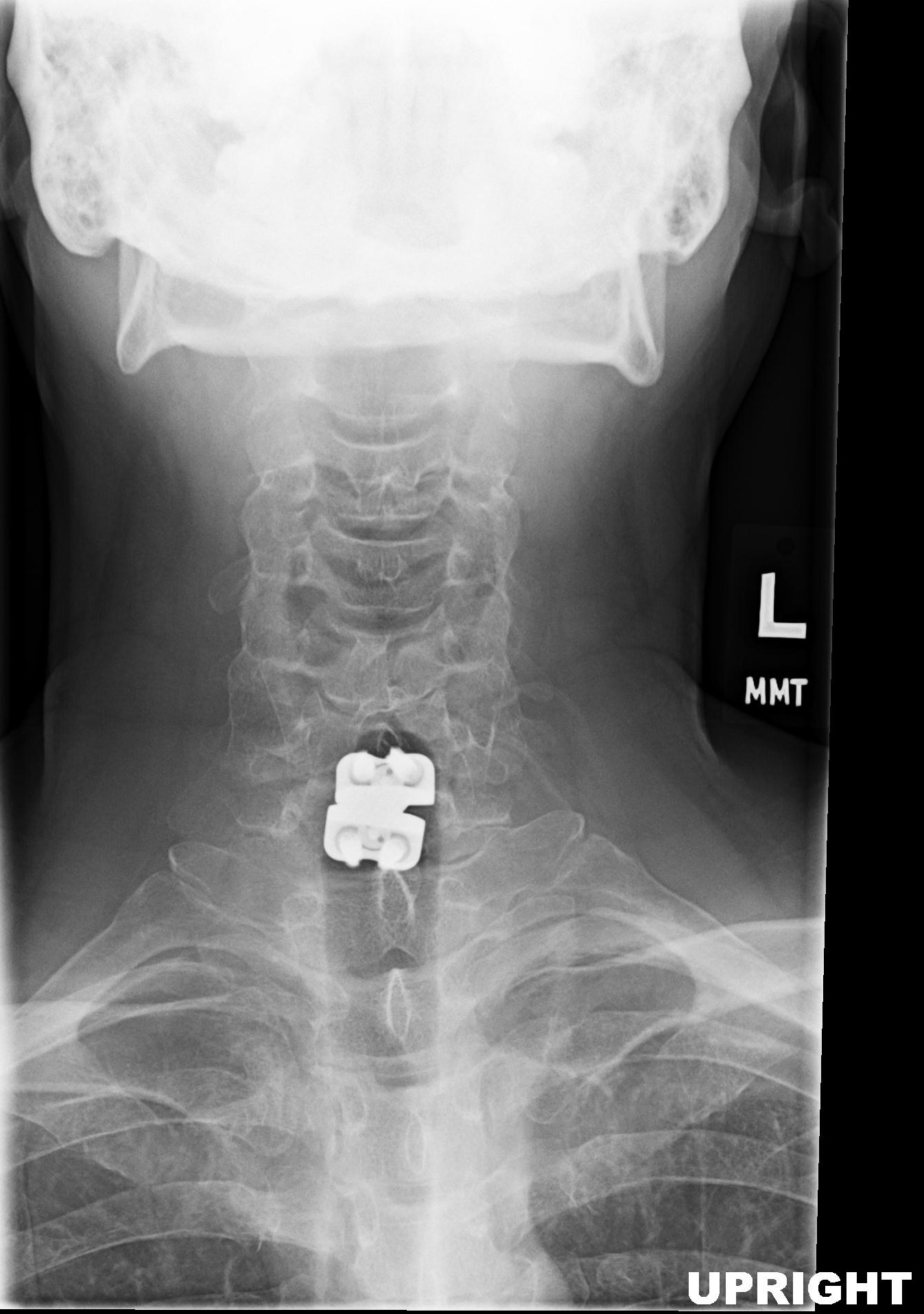 Cervical Symptoms Recur after Artificial Disc Replacement