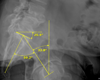Severe Sagittal Imbalance and Lumbar Spinal Stenosis in a Patient with ...