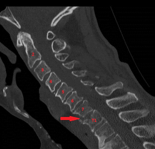 Failure to Recognize Traumatic Cervical Spinal Instability, C7-T1 ...