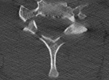 Traumatic Unilateral Cervical Spine Perched Facet