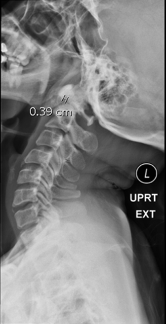 Chronic Type II Odontoid Fracture With C1-C2 Instability and Severe ...
