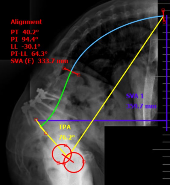 Severe Sagittal Imbalance Correction