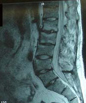 Low Back Pain with L1-L3 Degeneration and L1-L2 Instability