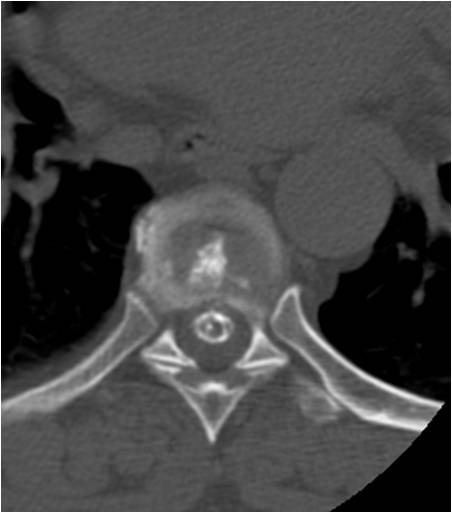 Thoracic Herniated Disc
