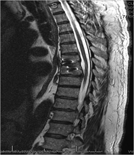 Thoracic Herniated Disc