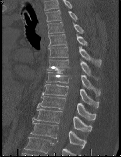 Thoracic Herniated Disc