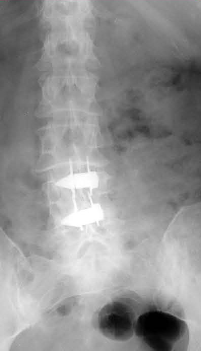 Lumbar Spinal Stenosis with Spondylolisthesis