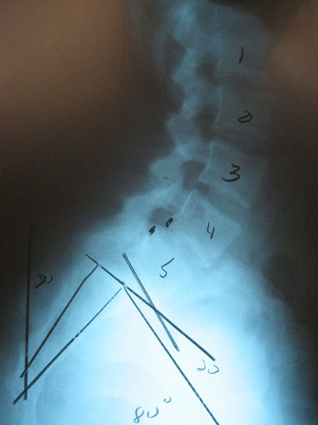 L5-S1 Grade II Spondylolisthesis