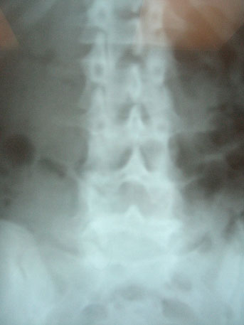 L5-S1 Grade II Spondylolisthesis