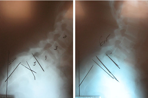 L5-S1 Grade II Spondylolisthesis