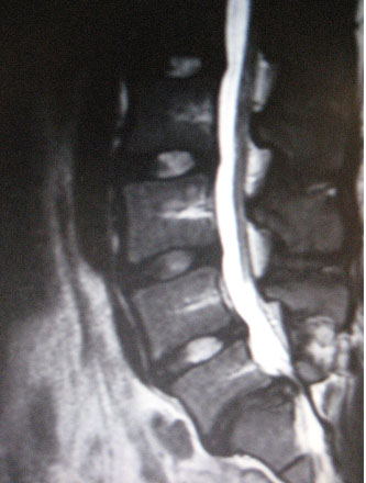 L5-S1 Grade II Spondylolisthesis