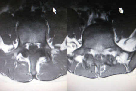 L5-S1 Grade II Spondylolisthesis