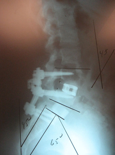 L5-S1 Grade II Spondylolisthesis