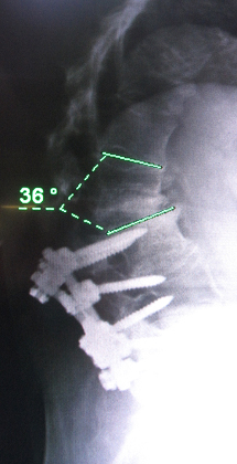 Laminectomy X Ray Xmlinkhub 2302