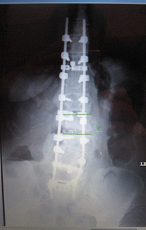 Post-laminectomy Instability