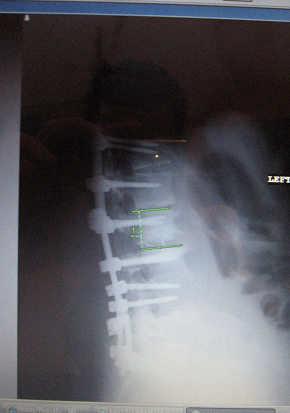 Post-laminectomy Instability