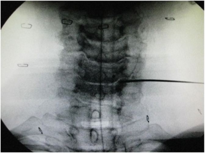 C4-C7 Spondylosis with Foraminal Stenosis