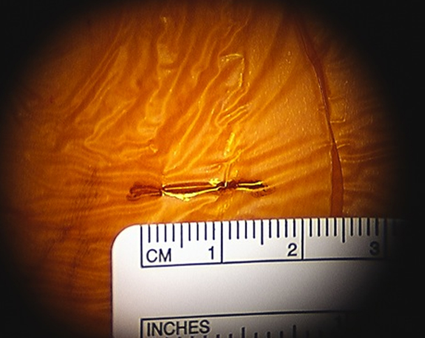 C4-C7 Spondylosis with Foraminal Stenosis