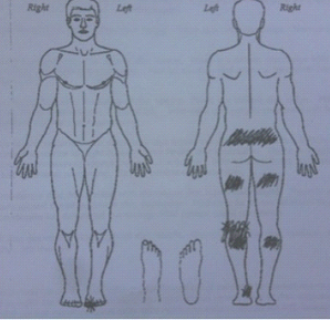 Construction Worker with Increasing Low Back Pain and Bilateral Leg Pain