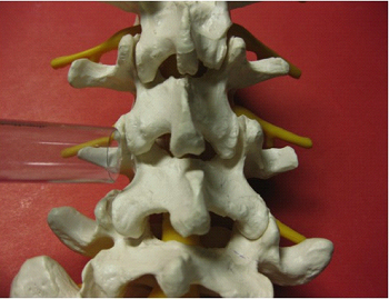 Construction Worker with Increasing Low Back Pain and Bilateral Leg Pain