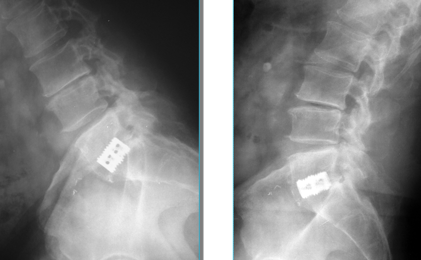 Lumbar Spine Degeneration X Ray