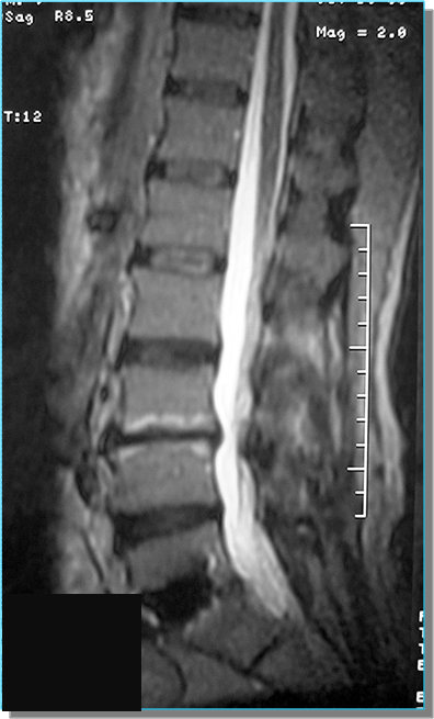Lumbar Disc Degeneration with Previous Surgeries and Constant Back Pain