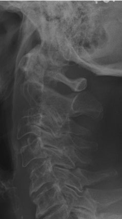 Lytic Lesion of the C2 Body