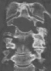 Lytic Lesion of the C2 Body