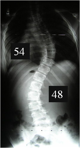 Spine Case: Adolescent Idiopathic Scoliosis in 15-year-old