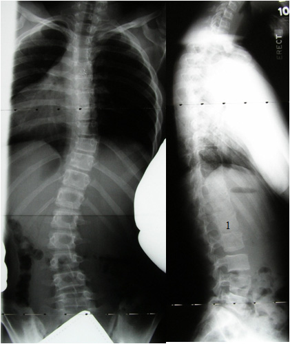 Spine Case: Adolescent Idiopathic Scoliosis in 15-year-old