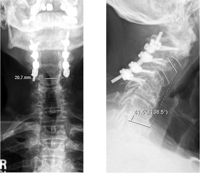 Kyphotic Angulation Cervical Spine
