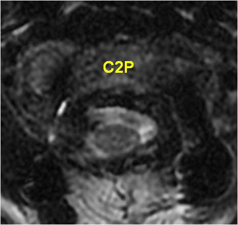 Spine Case: Fixed Cervical Kyphosis and Recurrent Myelopathy