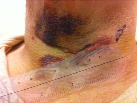 Spine Case: Fixed Cervical Kyphosis and Recurrent Myelopathy