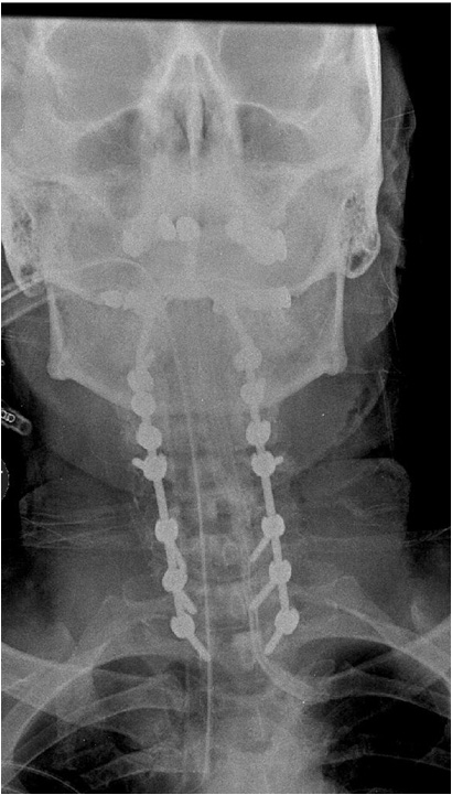 Kyphotic Angulation Cervical Spine