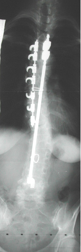 Spine Case | Previous Harrington Rod Causing Low Back Pain